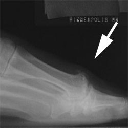 DJD & Hallux Rigidus : 네이버 블로그