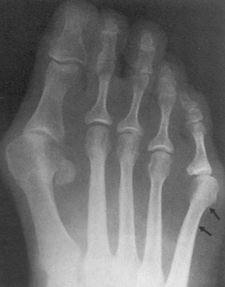 Bunionette Deformity - Foot & Ankle - Orthobullets