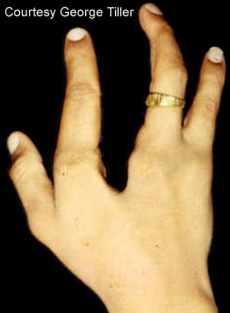 cleft hand - ekşi sözlük