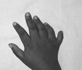 Polydactyly of Hand - Hand - Orthobullets