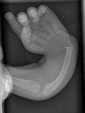 Radial Clubhand (radial deficiency) : 네이버 블로그