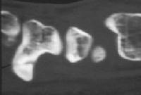 Hook of Hamate Fracture : 네이버 블로그