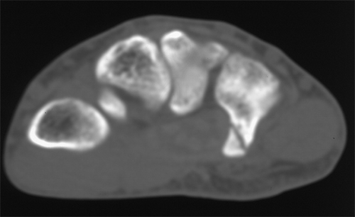 Hook of Hamate Fracture - Hand - Orthobullets