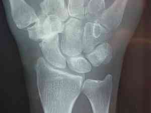 Preiser's Disease (Scaphoid AVN) - Hand - Orthobullets