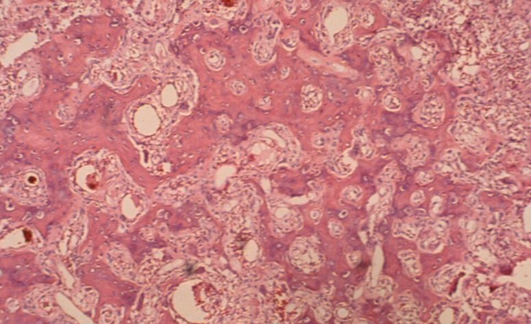 Osteoid Osteoma - Pathology - Orthobullets