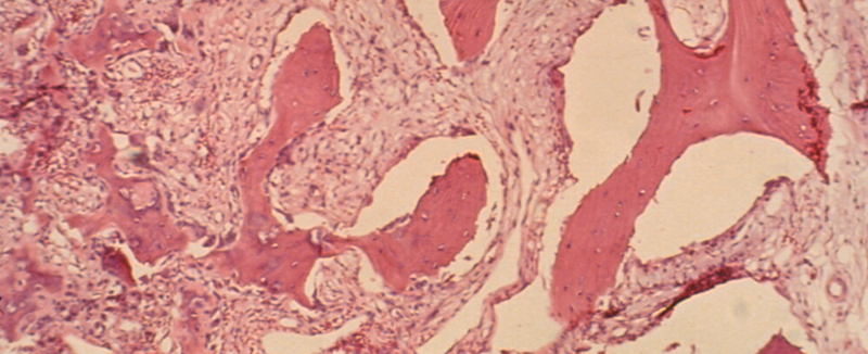 Osteoid Osteoma - Pathology - Orthobullets