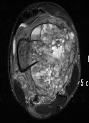 Telangiectatic Osteosarcoma - Pathology - Orthobullets
