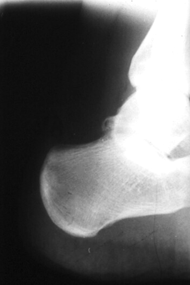 Chondroblastoma - Pathology - Orthobullets