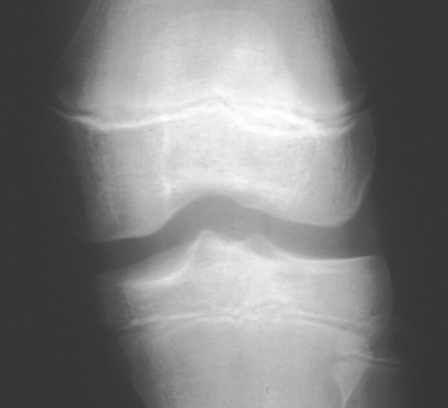 Chondroblastoma - Pathology - Orthobullets
