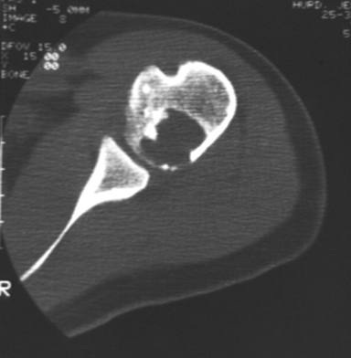 Chondroblastoma - Pathology - Orthobullets