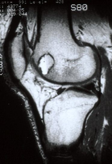 Chondroblastoma - Pathology - Orthobullets