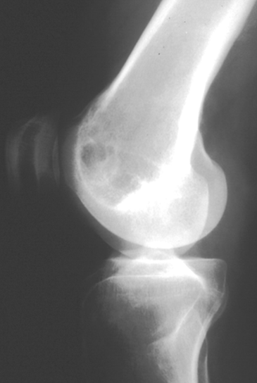 Chondroblastoma - Pathology - Orthobullets