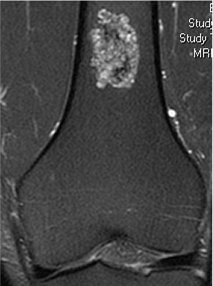 Enchondromas - Pathology - Orthobullets