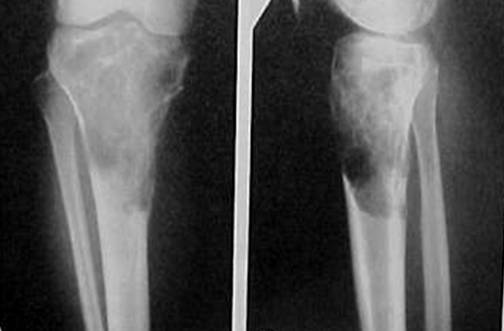 Desmoplastic Fibroma - Pathology - Orthobullets