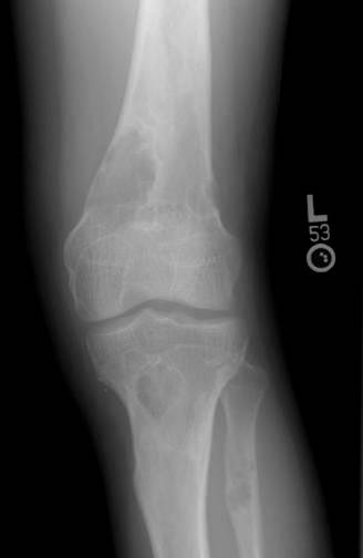 Non-Ossifying Fibroma - Pathology - Orthobullets