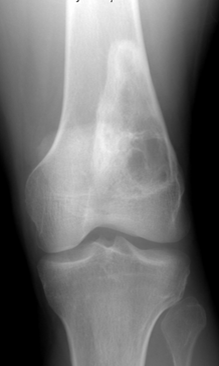 Osteoid Osteoma - Pathology - Orthobullets