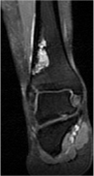 Non-Ossifying Fibroma - Pathology - Orthobullets