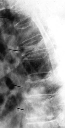 Multiple Myeloma - Pathology - Orthobullets