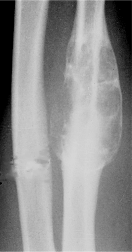 Aneurysmal Bone Cyst - Pathology - Orthobullets