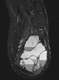 Aneurysmal Bone Cyst - Pathology - Orthobullets