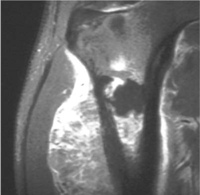Ewing's Sarcoma - Pathology - Orthobullets