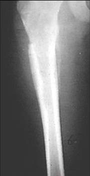 Ewing's Sarcoma - Pathology - Orthobullets