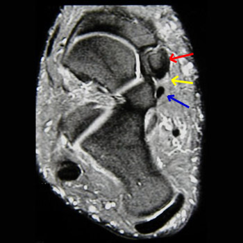 Accessory Navicular : 네이버 블로그