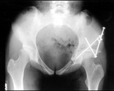 Developmental Dysplasia of the Hip : 네이버 블로그