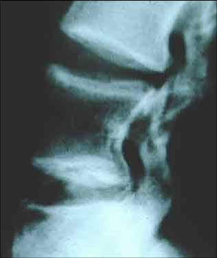 Achondroplasia : 네이버 블로그