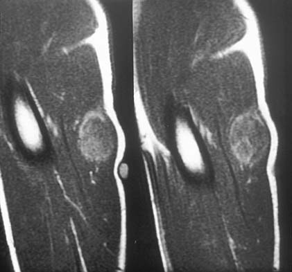 Rhabdomyosarcoma - Pathology - Orthobullets