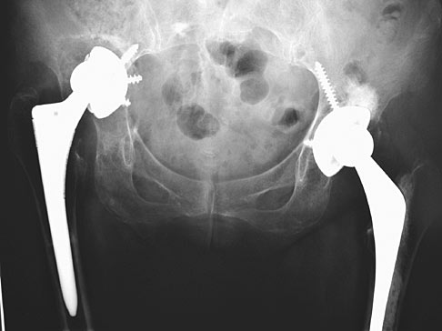 Revision Total Hip Arthroplasty : 네이버 블로그