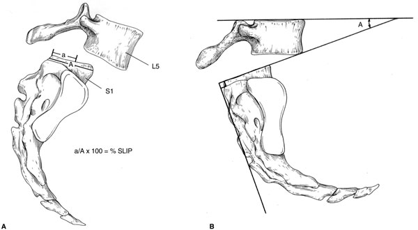 Pediatric Spondylolisthesis (Developmental) : 네이버 블로그
