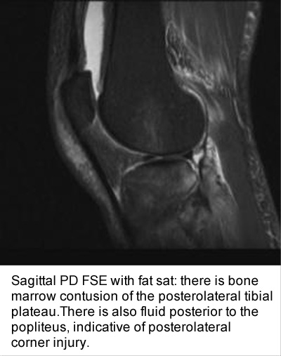 Posterolateral Corner Injury - Knee & Sports - Orthobullets