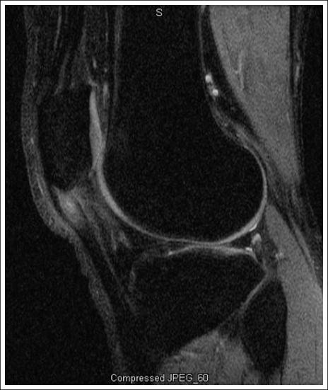 Patellar Tendonitis : 네이버 블로그
