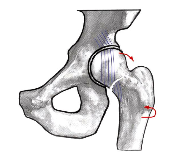 Femoral Neck Fractures - Trauma - Orthobullets