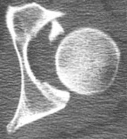 Hip Dislocation - Trauma - Orthobullets