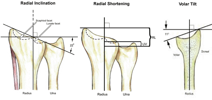 Distal Radius Fractures - Trauma - Orthobullets