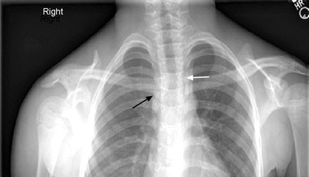 Sternoclavicular Dislocation : 네이버 블로그